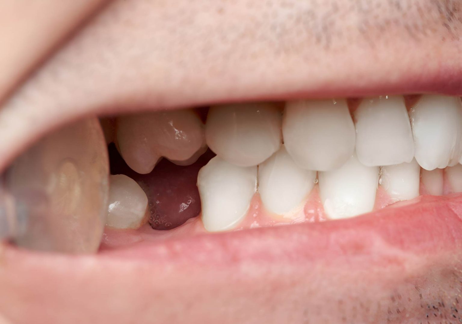 Comparing Different Front Tooth Replacement Options